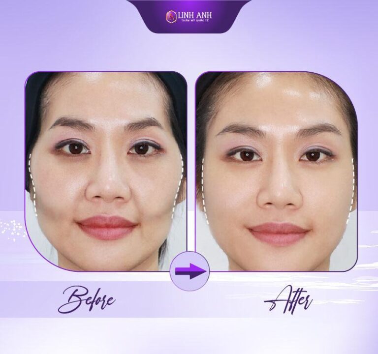 Giá tiêm filler 1CC cho từng vùng trên mặt là bao nhiêu?