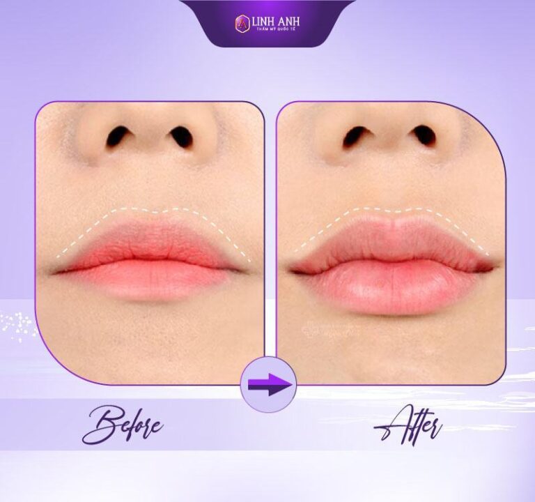 Giá tiêm filler 1CC cho từng vùng trên mặt là bao nhiêu?