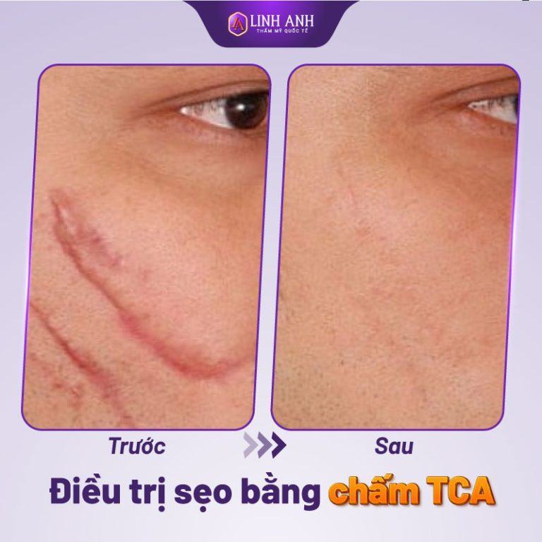 Trị sẹo lồi giá bao nhiêu tiền? Bảng giá cắt sẹo lồi mới nhất 2024