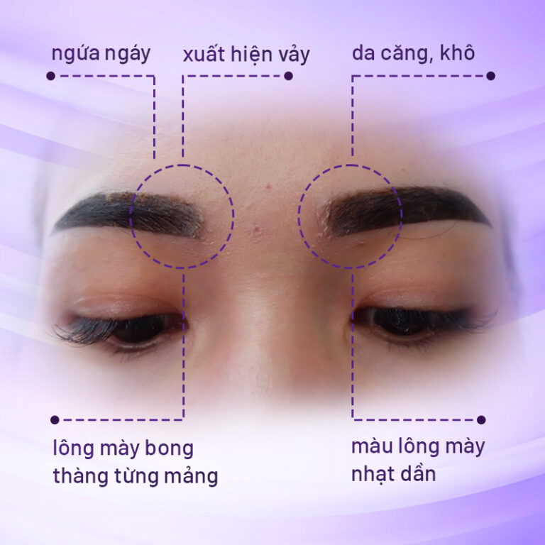 Cách nhận biết lông mày bong - Hình ảnh lông mày đang bong