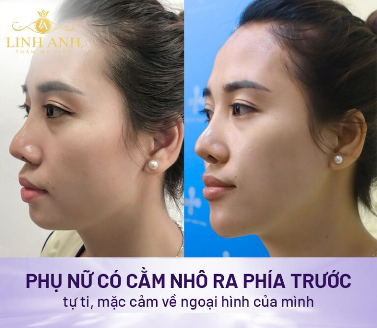 Xem tướng cằm nhô ra phía trước chi tiết và cách khắc phục