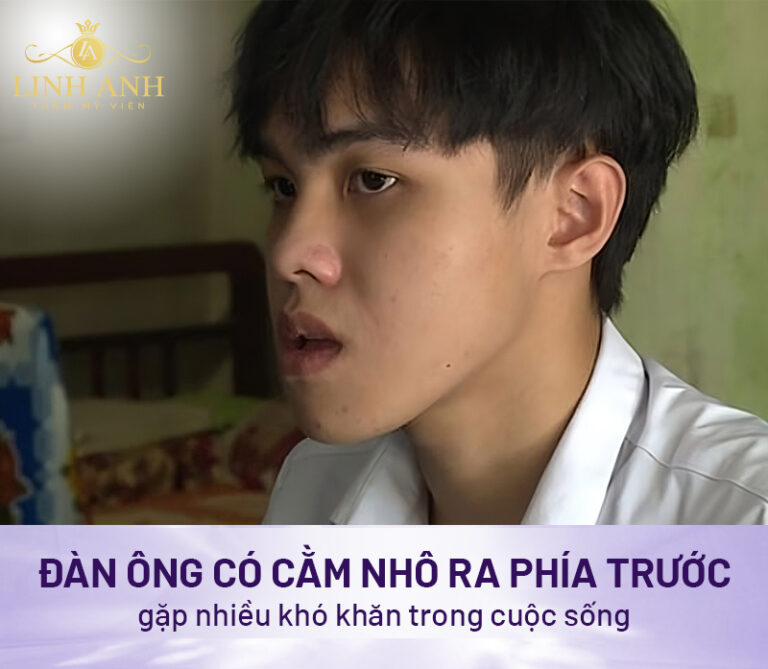Xem tướng cằm nhô ra phía trước chi tiết và cách khắc phục