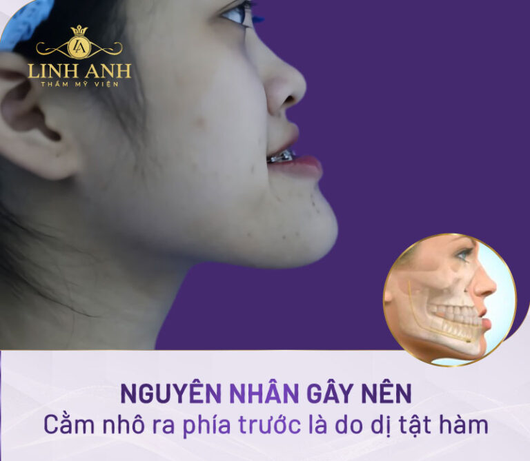 Xem tướng cằm nhô ra phía trước chi tiết và cách khắc phục