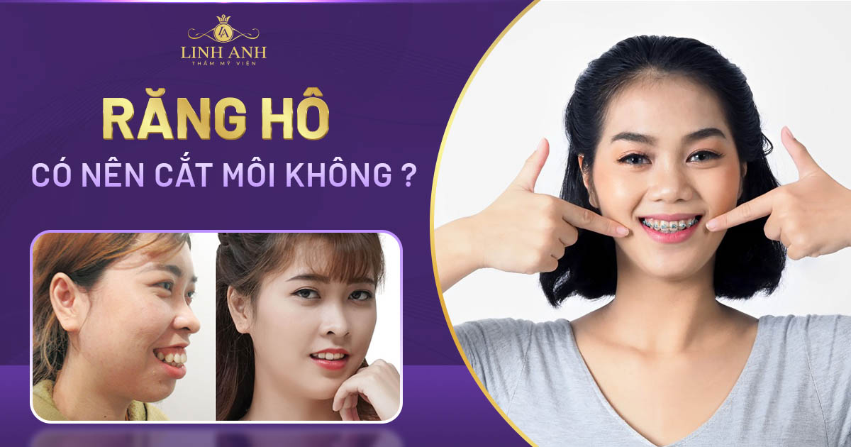 Răng hô có nên cắt môi không?
