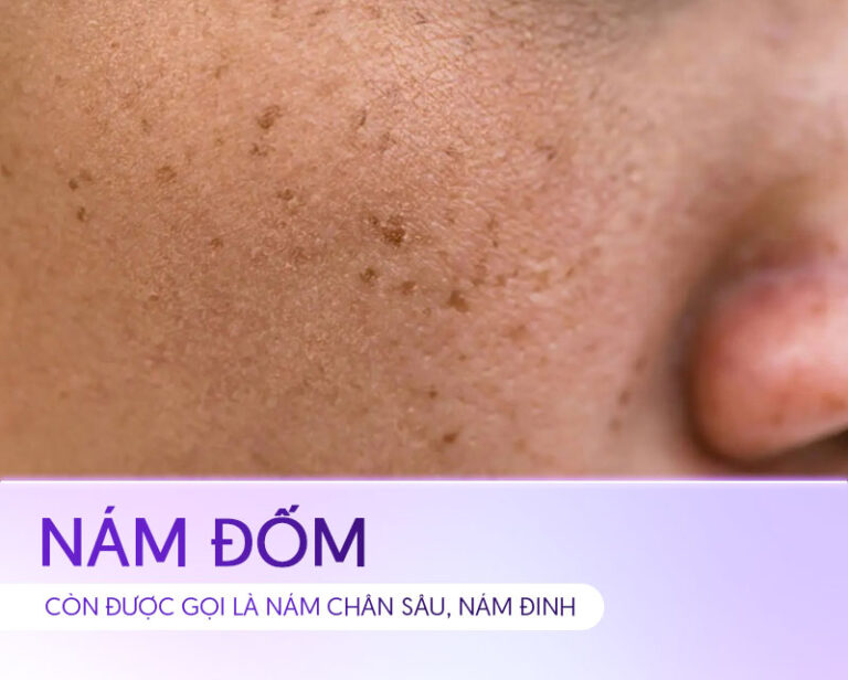 Nám đốm là gì? Cách điều trị nám đốm an toàn và hiệu quả
