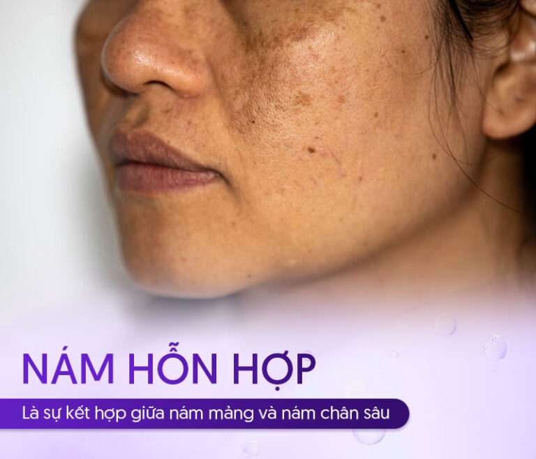 Nám hỗn hợp là gì? Nguyên nhân & cách điều trị an toàn, hiệu quả