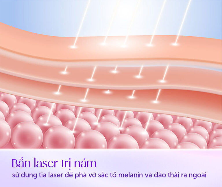 Bắn laser trị nám có hiệu quả không? Bắn 1 lần bao nhiêu tiền?