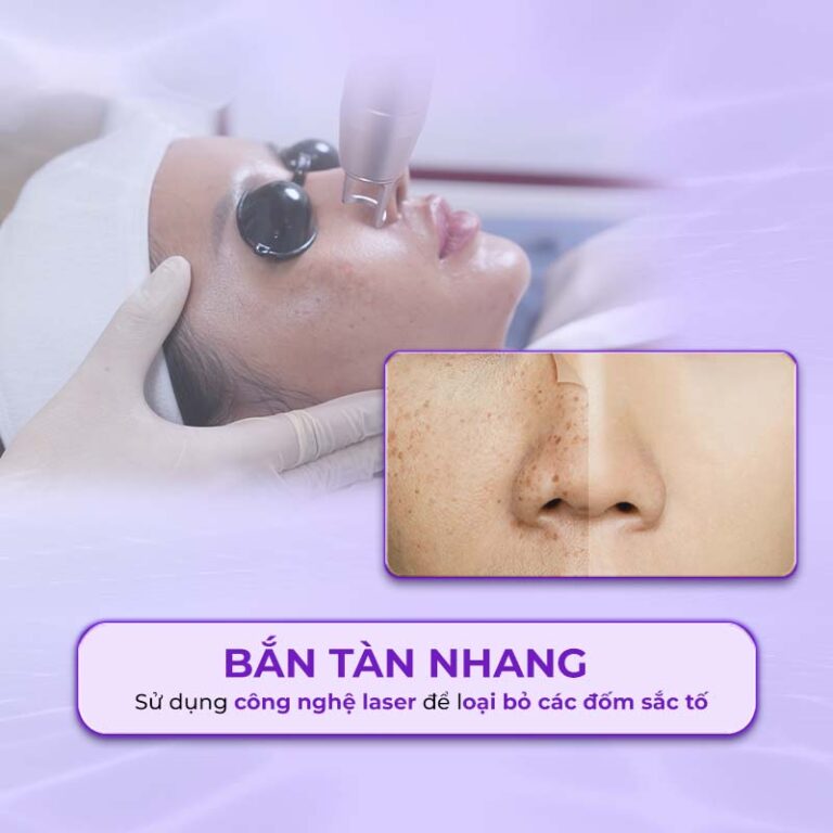 Bắn tàn nhang bằng laser và những điều bạn cần biết