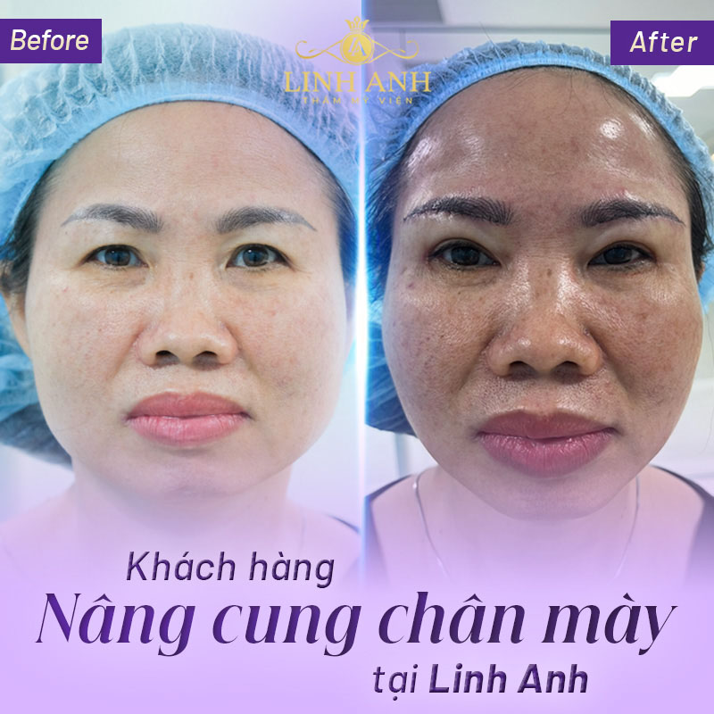 Nâng cung chân mày giấu chỉ là gì? Ưu và nhược điểm